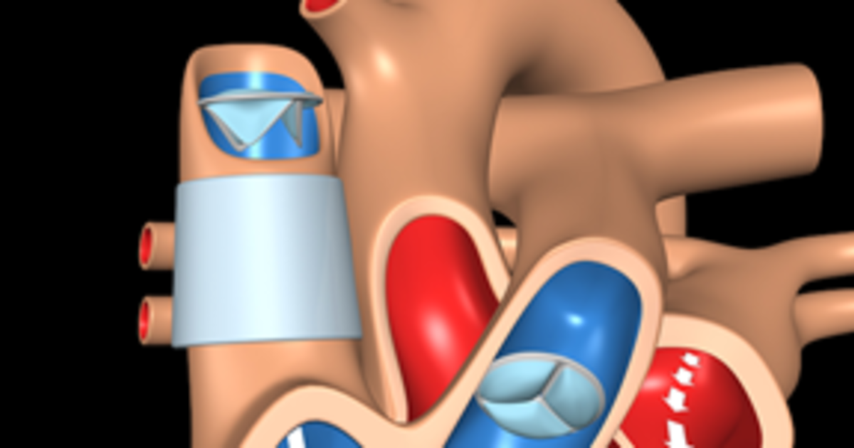 The One-Way Heart Assist Valve | Indiegogo