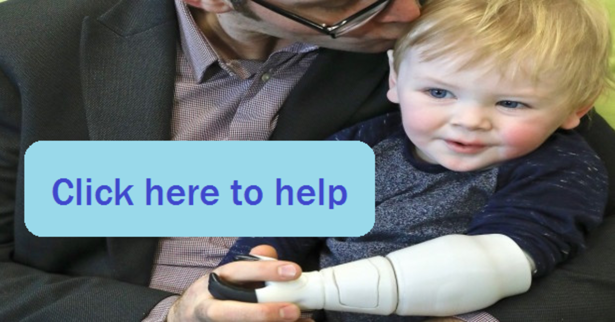 Ambionics: Unique Prosthetics - as seen on TV | Indiegogo