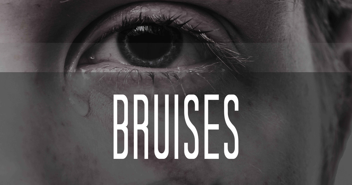 Bruises | Indiegogo