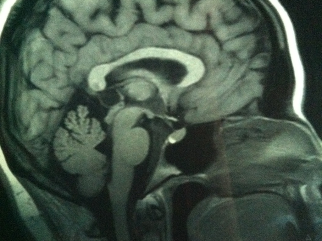 Pineal brain cyst removal | Indiegogo