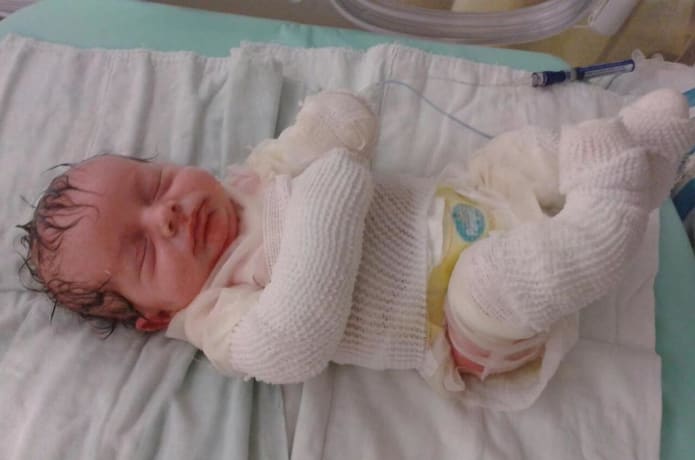 Help Save Easton- baby battling Epidermolysis Bullosa- EB | Indiegogo