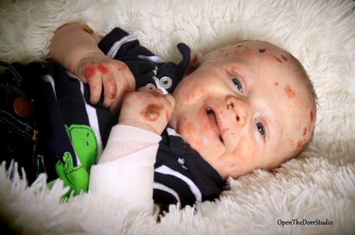 Help for Eli - a sweet baby battling Epidermolysis Bullosa | Indiegogo