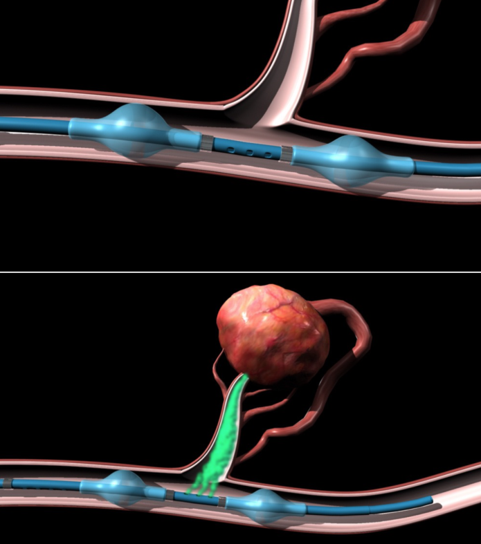 IsoFlow -The Latest in Cancer Treatment Technology | Indiegogo