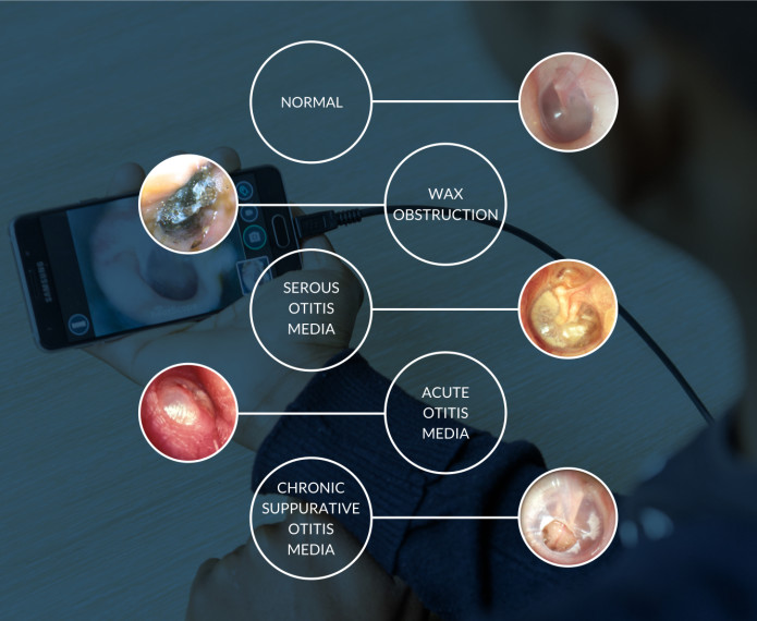 hearScope : Next generation smartphone otoscope | Indiegogo